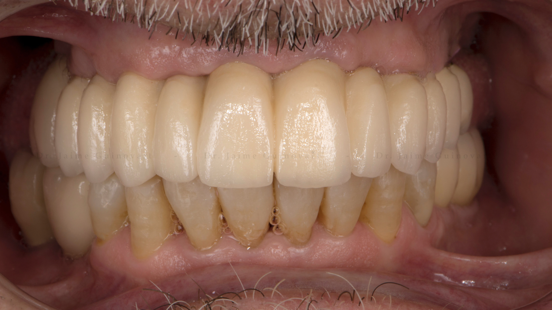 Rehabilitación Superior e Inferior Completa – Dr. Jaime Guinovart